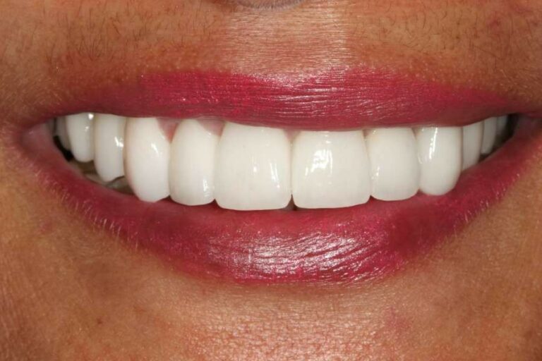 Dr Adam Patel – Clinical and aesthetic excellence with implants